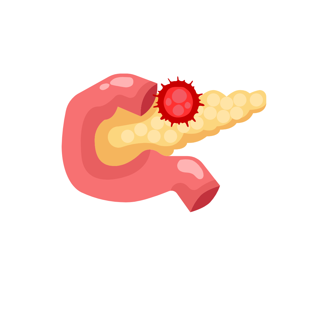 Pancreatic cancer projects - Center for Surgical Science (CSS)